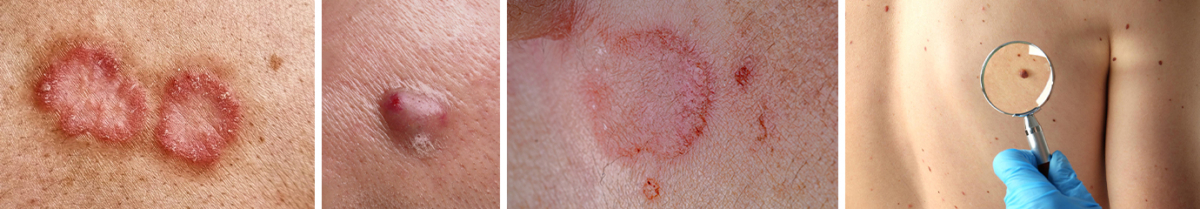 Understanding Actinic Keratosis Treatment: A Comprehensive Guide ...